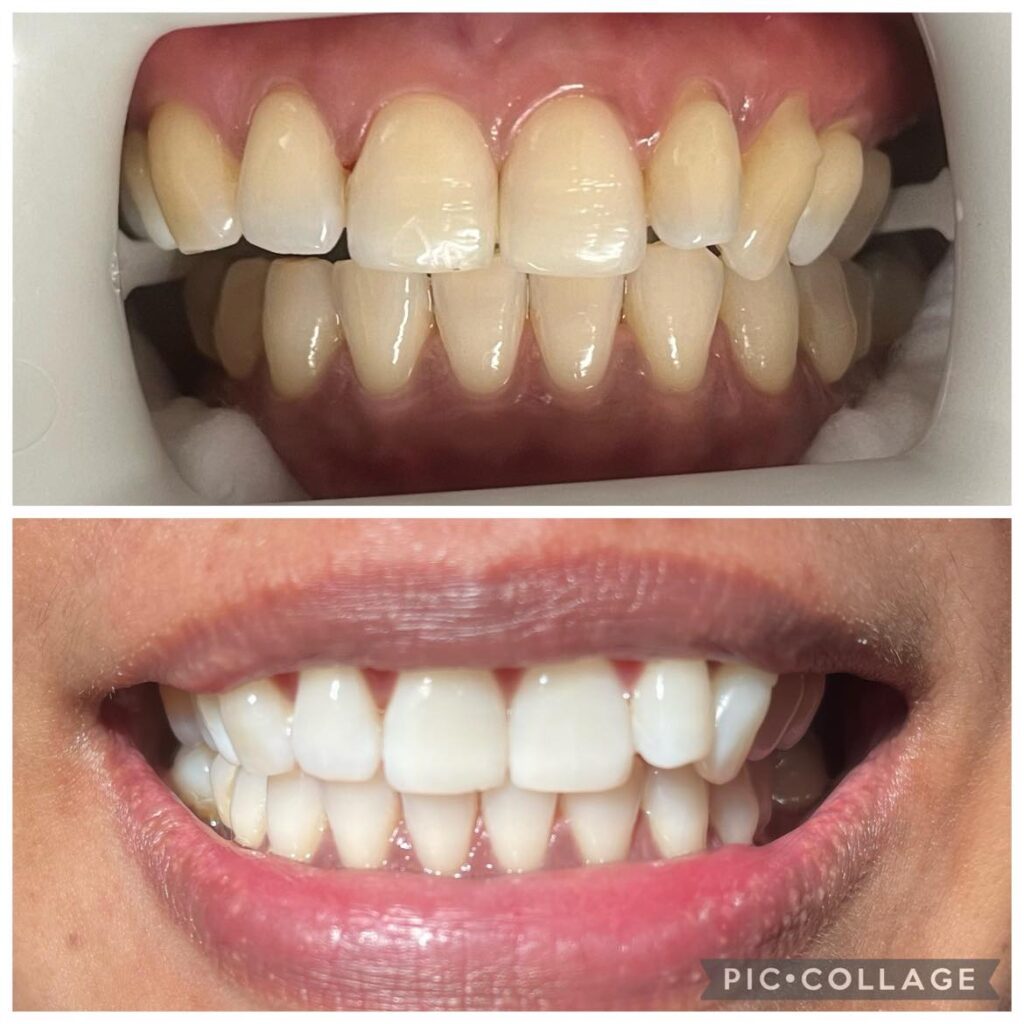 Professional Teeth Whitening Jacksonville FL - Jax Smiles Dentistry